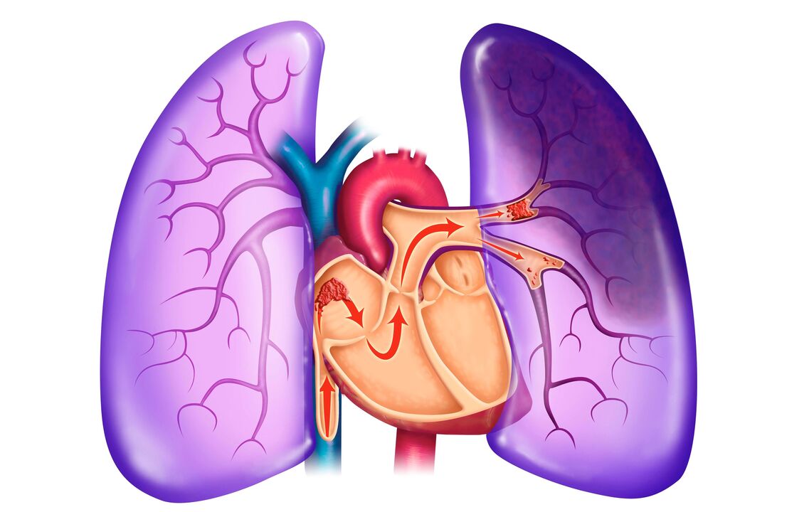 Arteriálna hypertenzia (hypertenzia): príčiny, príznaky, liečba, prečo ...